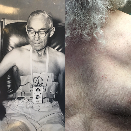 Pacemakers: Past and present - Mayo Clinic Health System