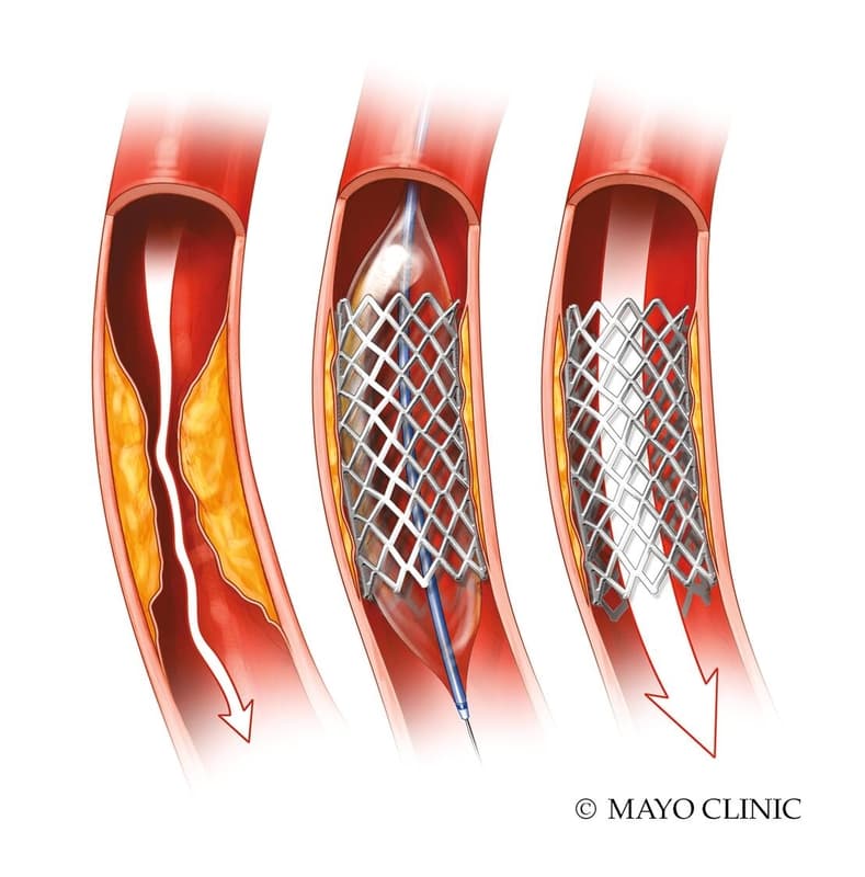 Vascular Treatments in La Crosse - Mayo Clinic Health System